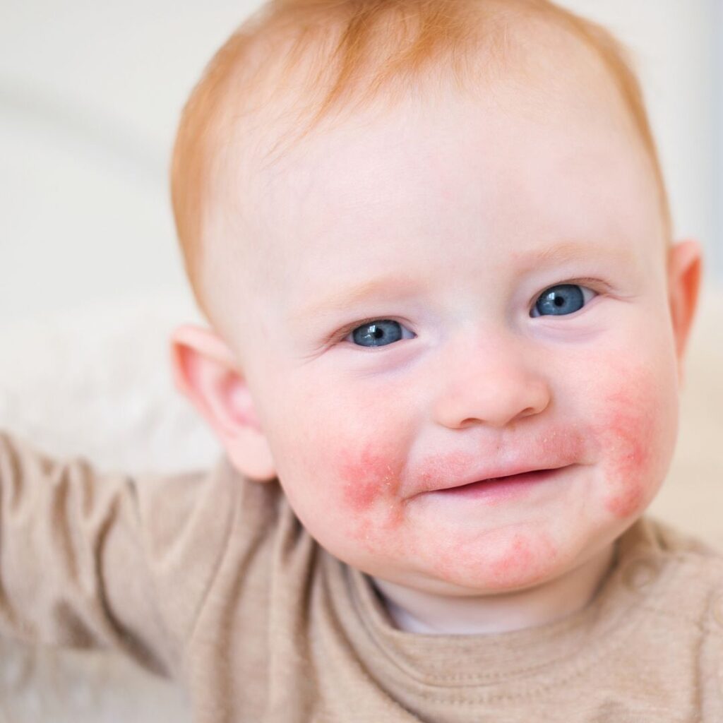 Common Skin Conditions: What's Contagious and What's Not? - Bryn Mawr ...