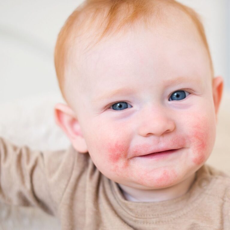 Common Skin Conditions: What's Contagious and What's Not? - Bryn Mawr ...