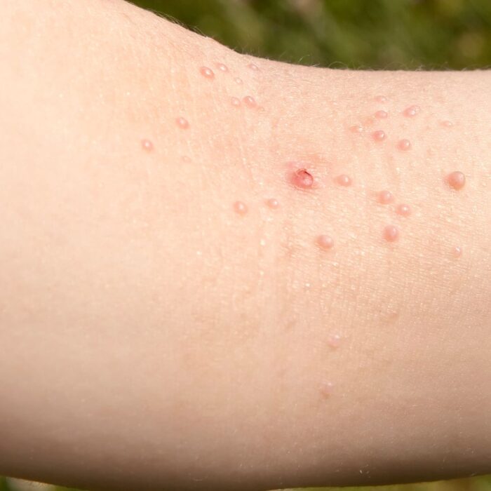 Common Skin Conditions: What's Contagious and What's Not? - Bryn Mawr ...
