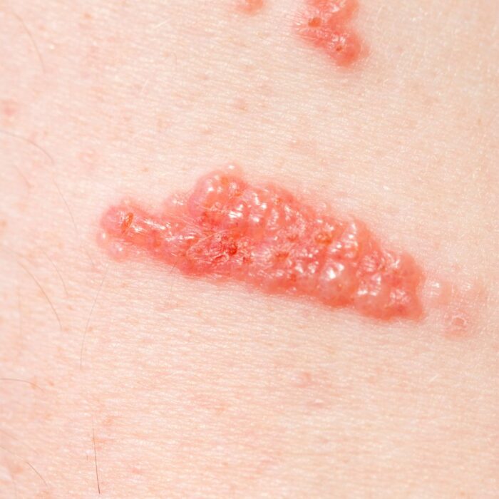 Common Skin Conditions: What's Contagious and What's Not? - Bryn Mawr ...