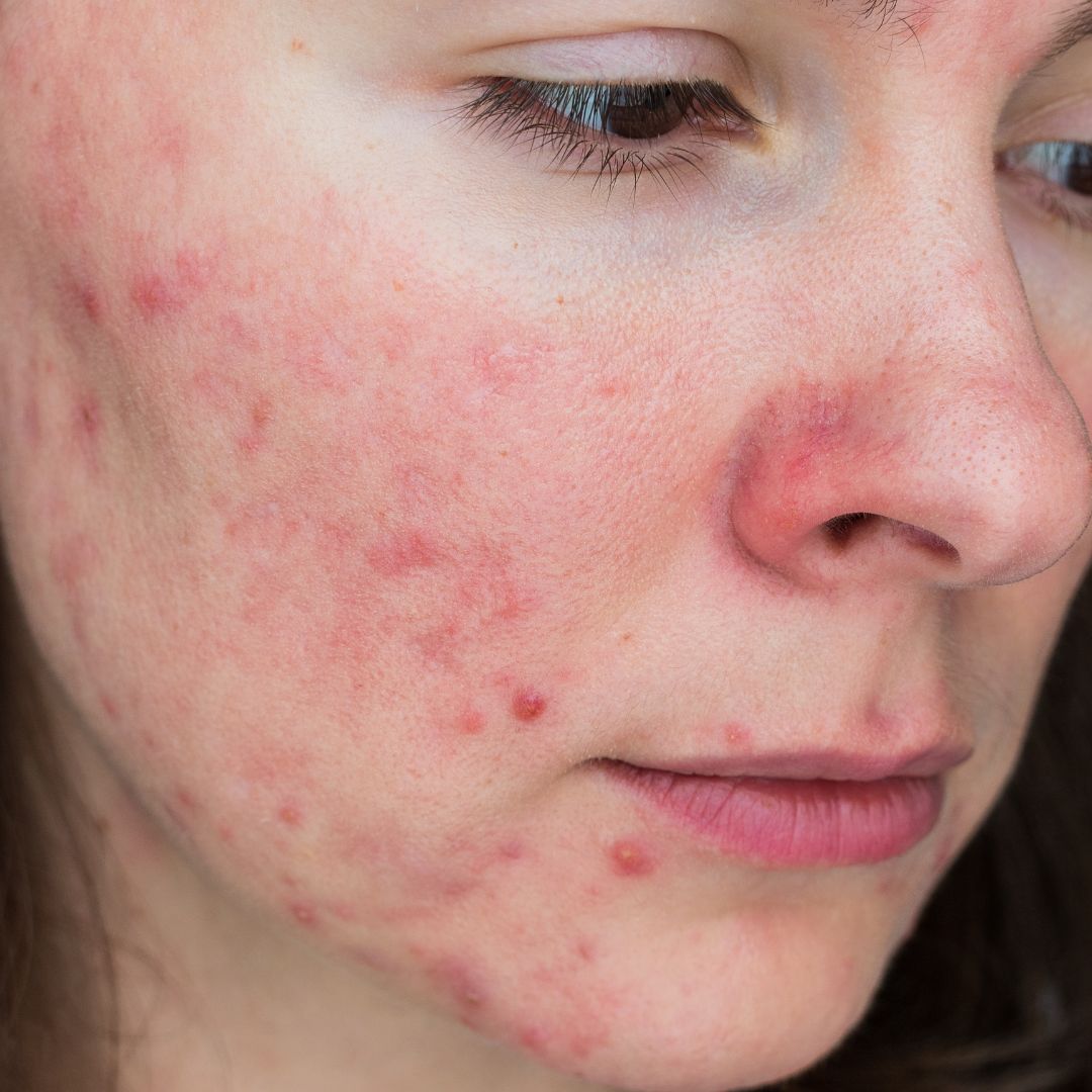 Common Skin Conditions: What's Contagious and What's Not? - Bryn Mawr ...