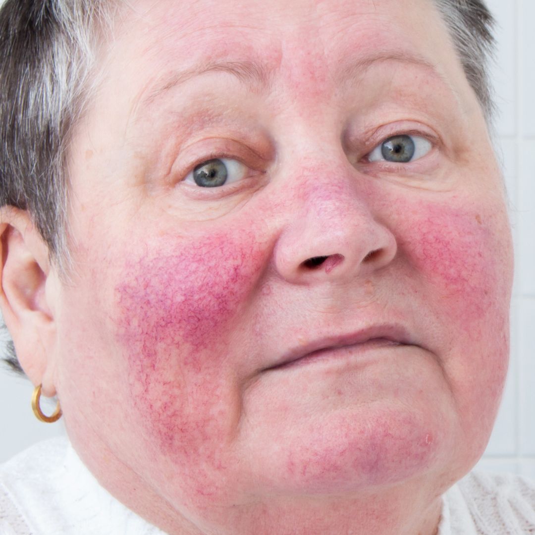 Common Skin Conditions: What's Contagious and What's Not? - Bryn Mawr ...