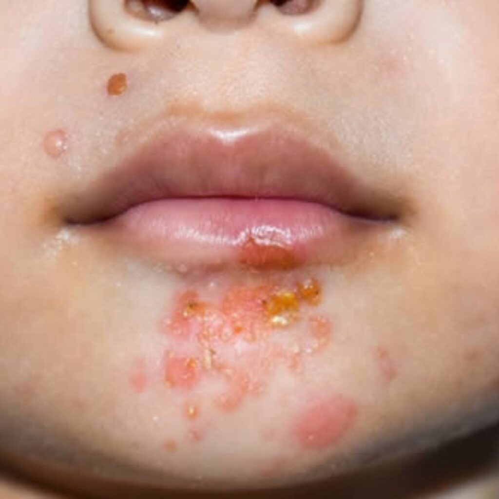 Common Skin Conditions: What's Contagious and What's Not? - Bryn Mawr ...