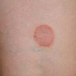 Common Skin Conditions: What's Contagious and What's Not? - Bryn Mawr ...