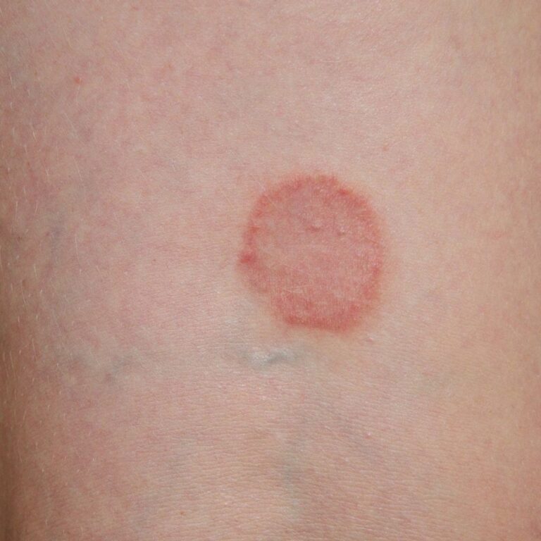 Common Skin Conditions: What's Contagious and What's Not? - Bryn Mawr ...