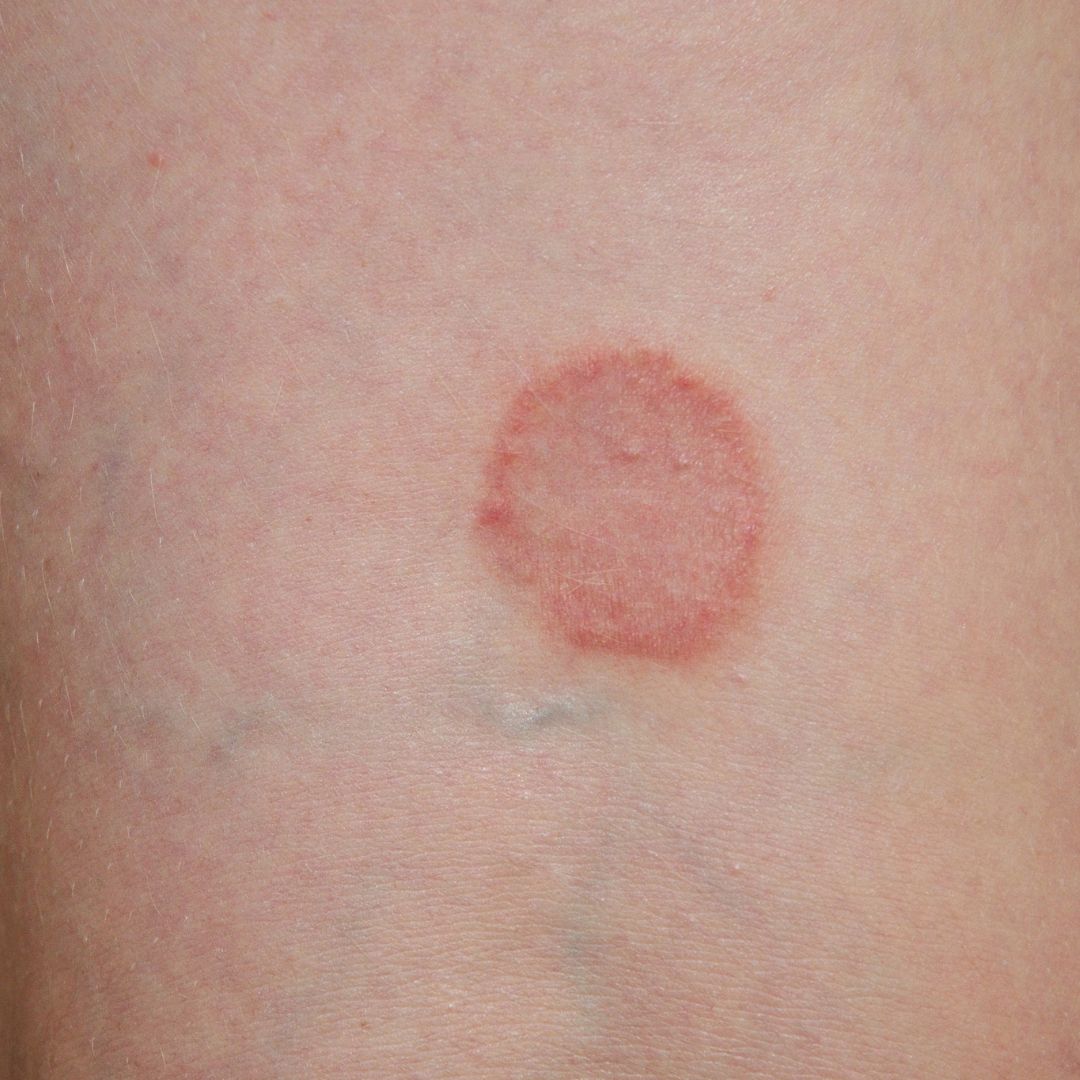 Common Skin Conditions: What's Contagious and What's Not? - Bryn Mawr ...