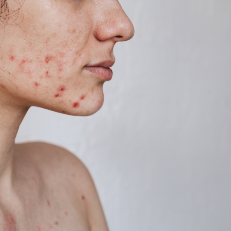 Common Skin Conditions: What's Contagious and What's Not? - Bryn Mawr ...