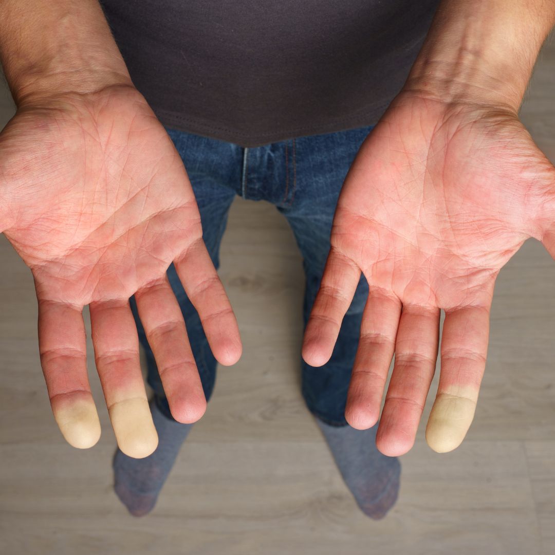 Raynaud’s Syndrome: Overview, Causes and Treatments
