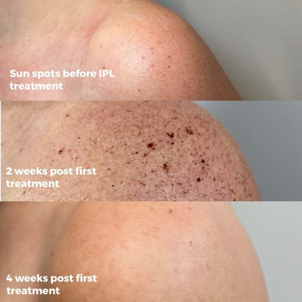 Treating Red and Brown Spots with Laser Technology.