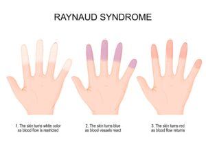 Raynaud’s Syndrome: Overview, Causes and Treatments